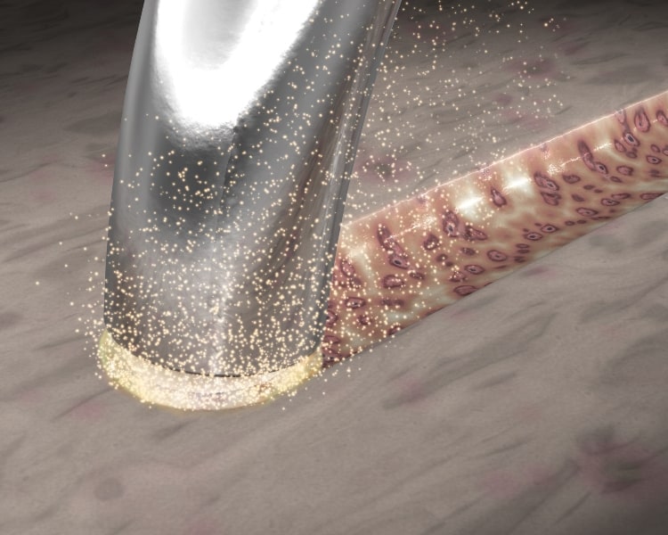 New Method of Painless Tonsillectomy | Dr Paulose