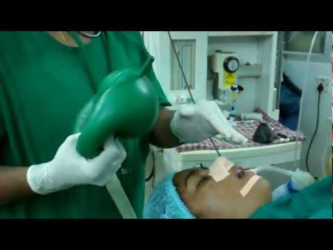 General Anesthesia for ENT Operations: Extubation Techniques Explained ...