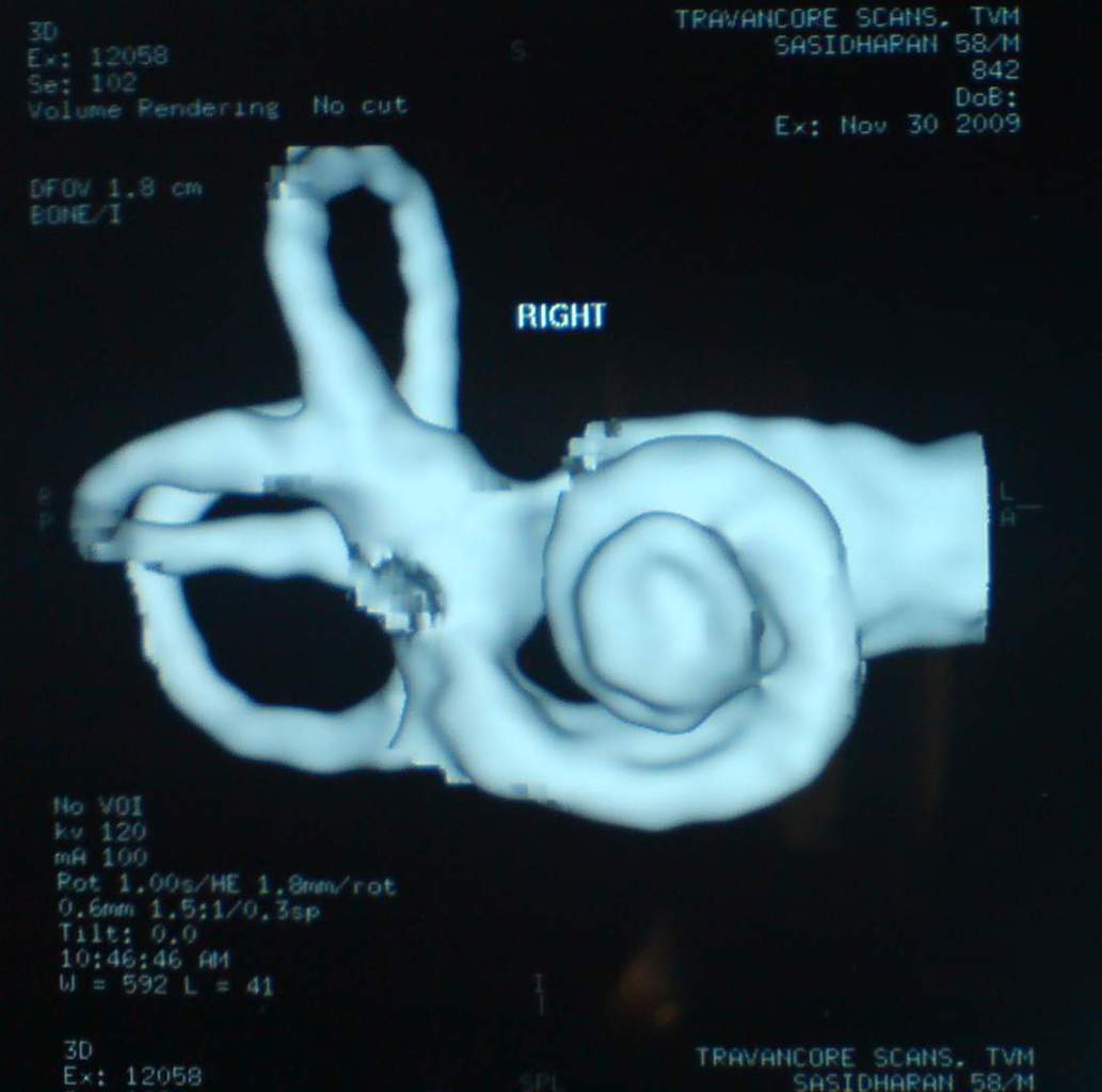 Cochlear Implant-Pre op 3D CT images