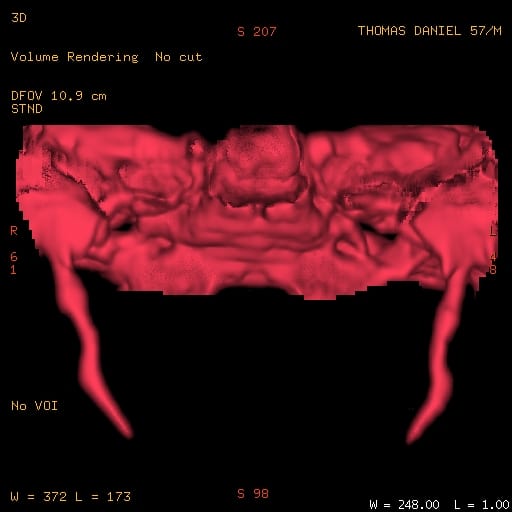 Eagles Stylohyoid Syndrome-Surgery in Trivandrum Kerala India.