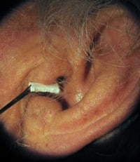 Fungus infection of the Ear-Otomycosis - Dr Paulose